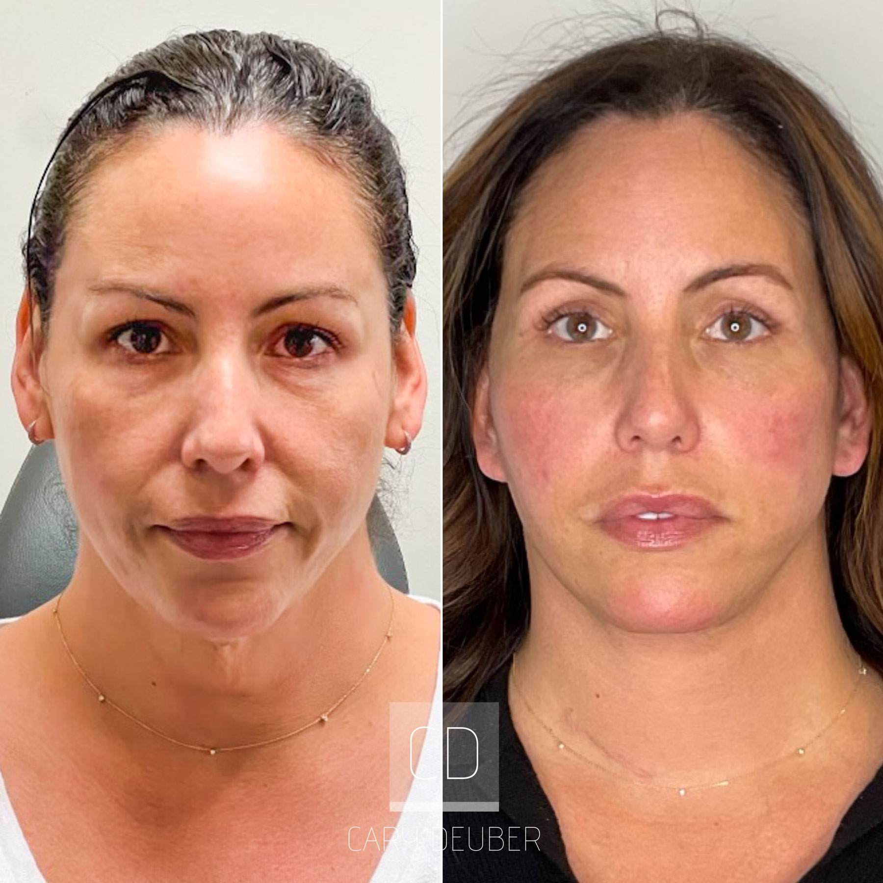 Cary - Botox - Lemmon Avenue Plastic Surgery & Laser Center | Dr. Mark ...