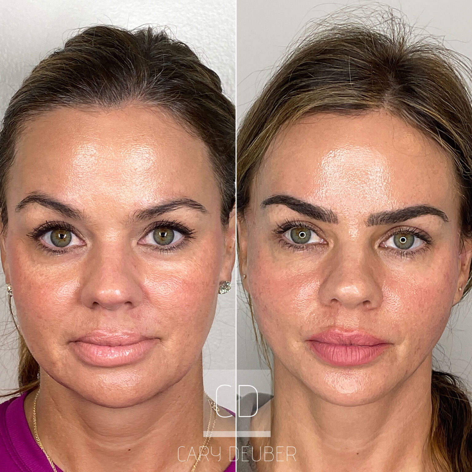 Before & After Archive - Lemmon Avenue Plastic Surgery & Laser Center ...