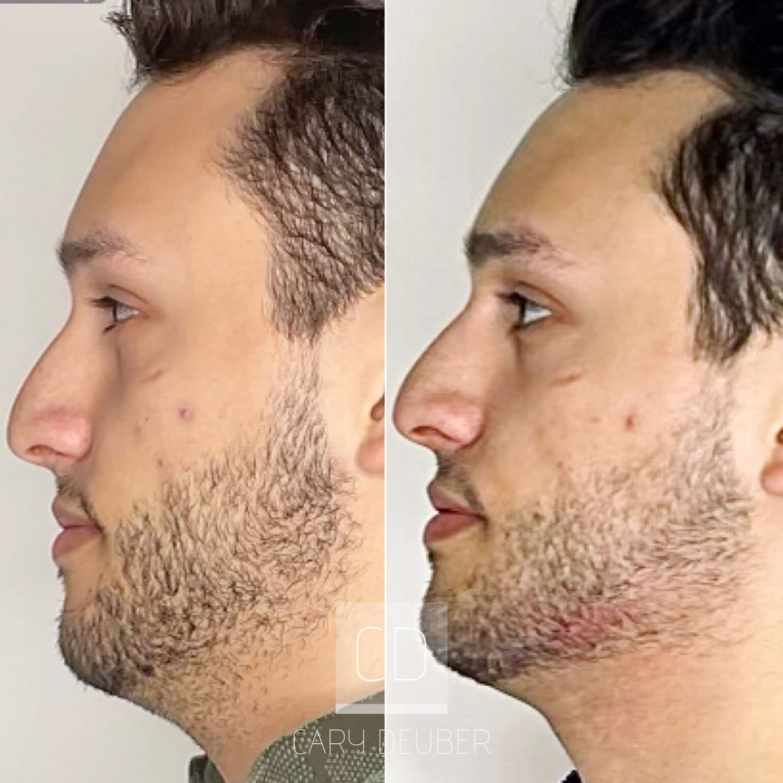 Cary - Chin and Jawline 1 - Lemmon Avenue Plastic Surgery & Laser ...