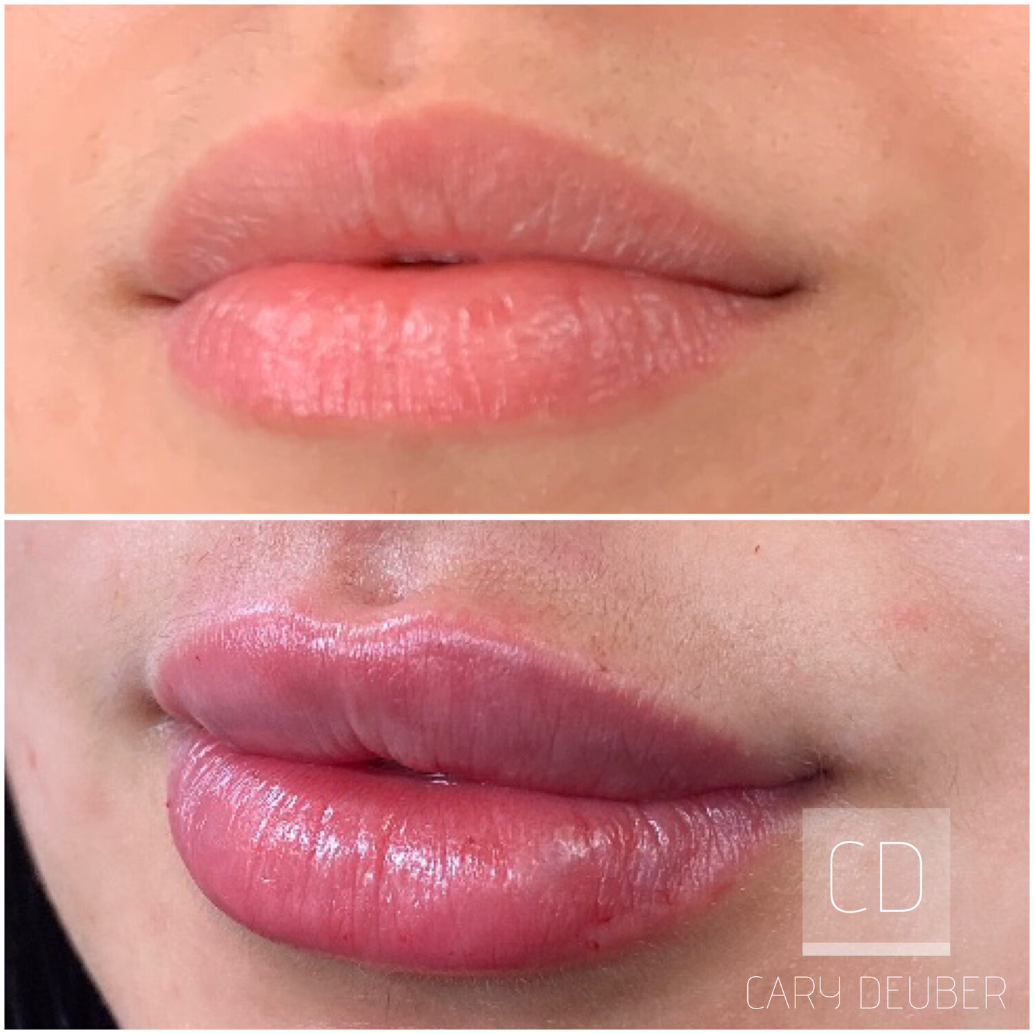 Before & After Archive - Lemmon Avenue Plastic Surgery & Laser Center ...