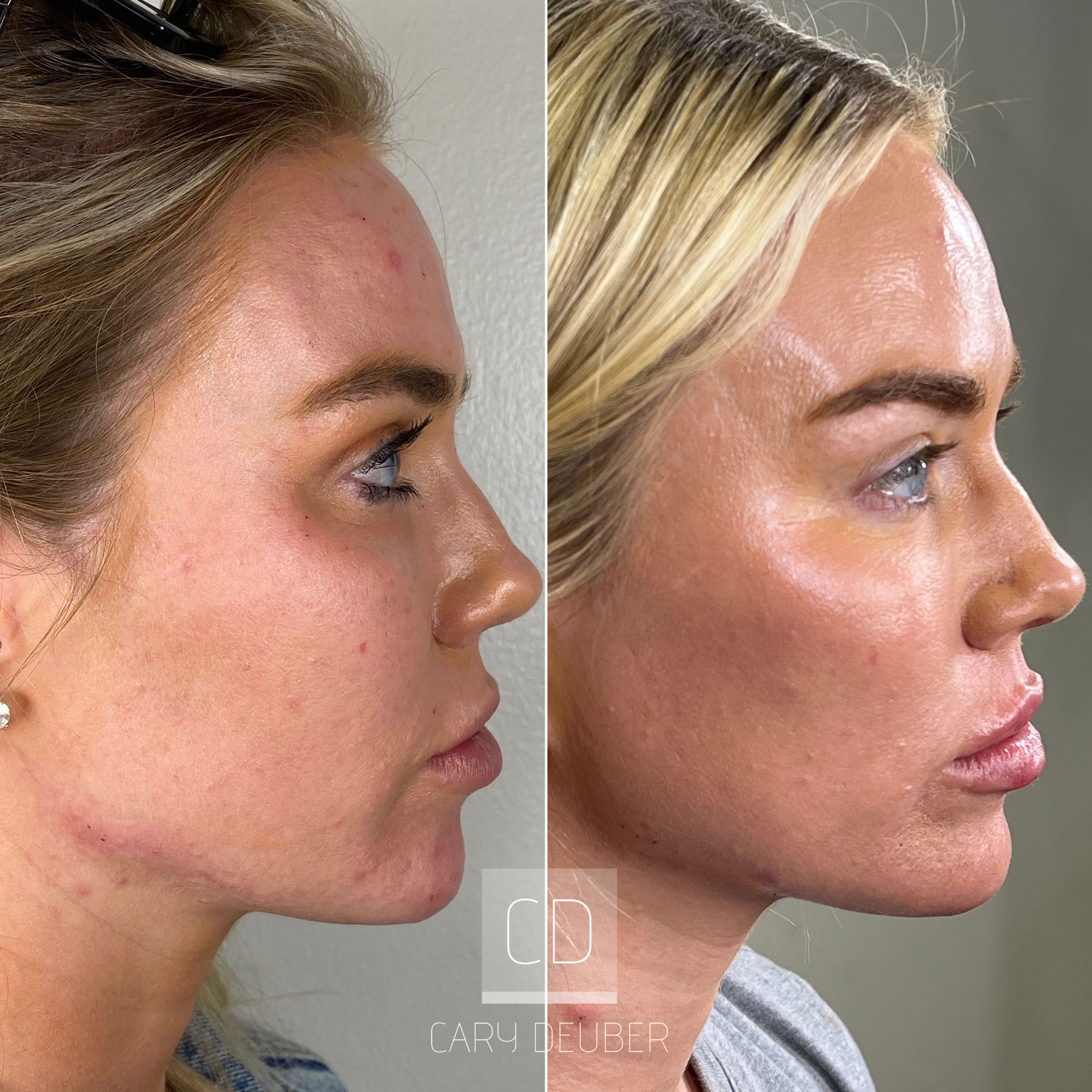 Cary - Filler 1 - Lemmon Avenue Plastic Surgery & Laser Center | Dr ...