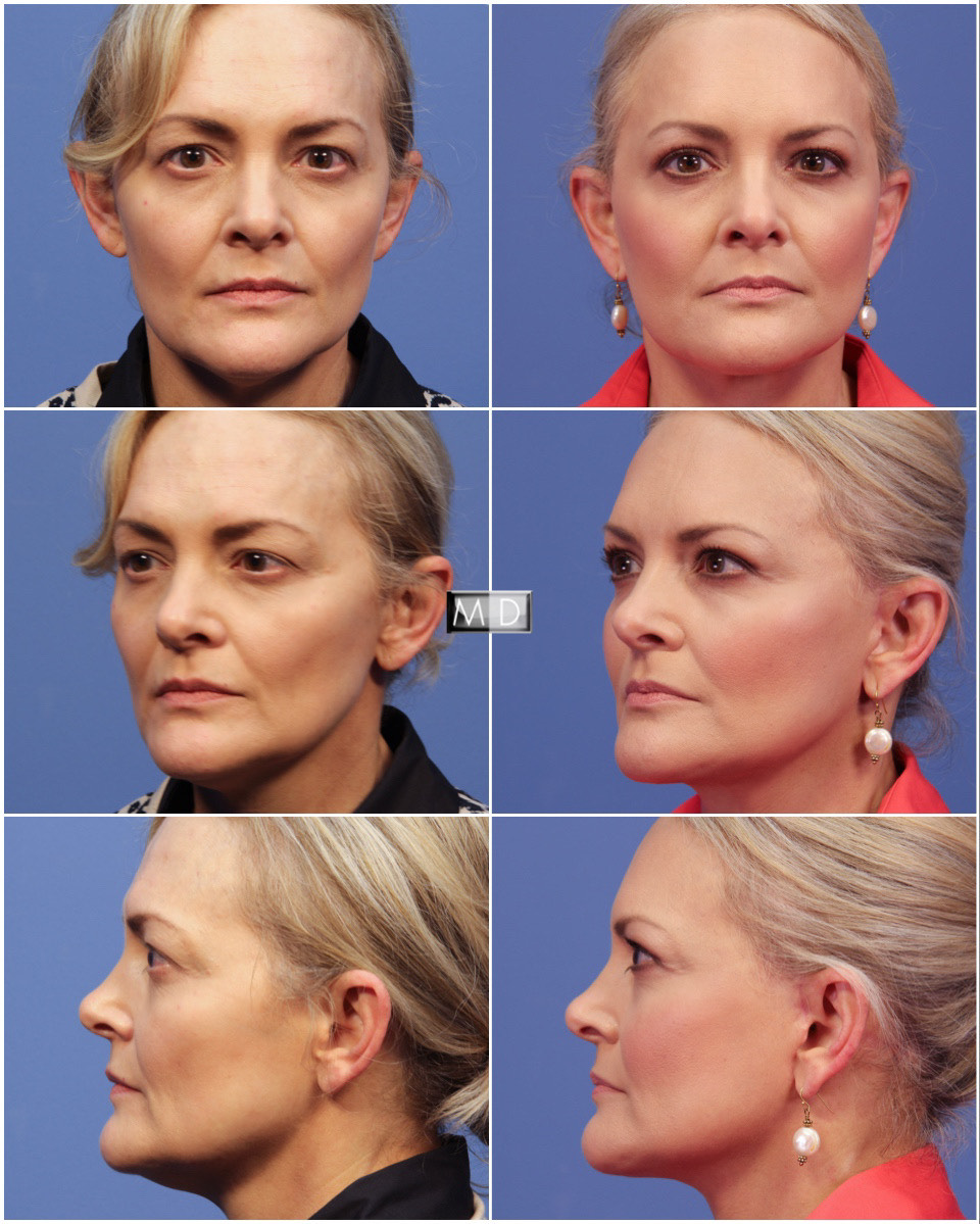Dr Deuber - Facelift 6 - Lemmon Avenue Plastic Surgery & Laser Center ...