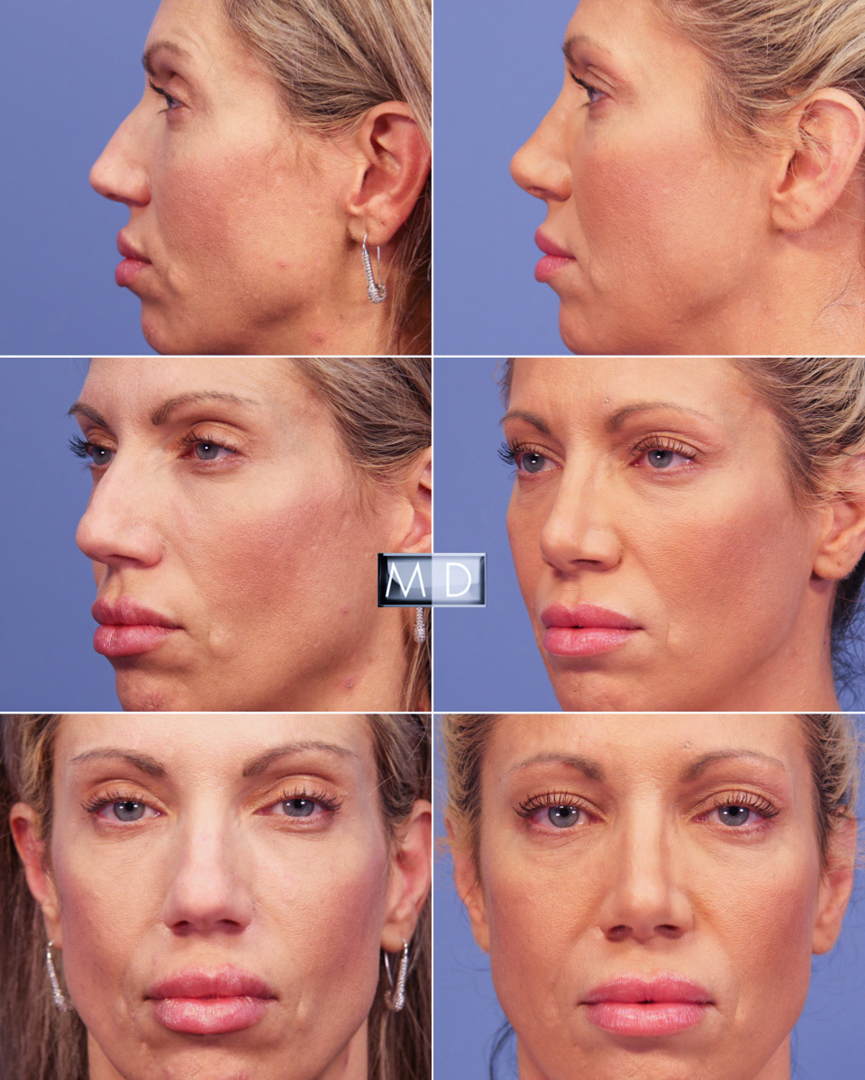 Dr Deuber - Rhinoplasty 2 - Lemmon Avenue Plastic Surgery & Laser ...
