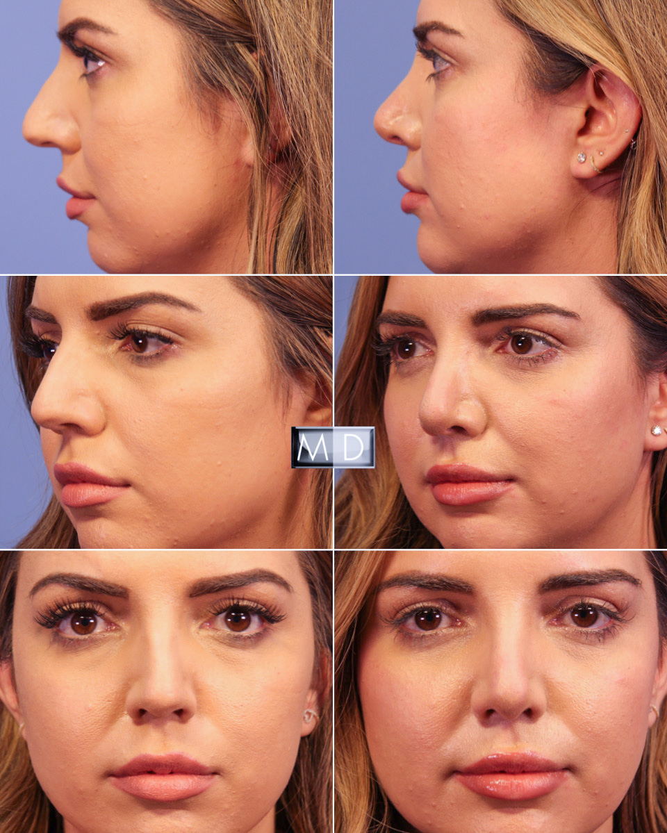 Dr Deuber - Rhinoplasty 3 - Lemmon Avenue Plastic Surgery & Laser ...