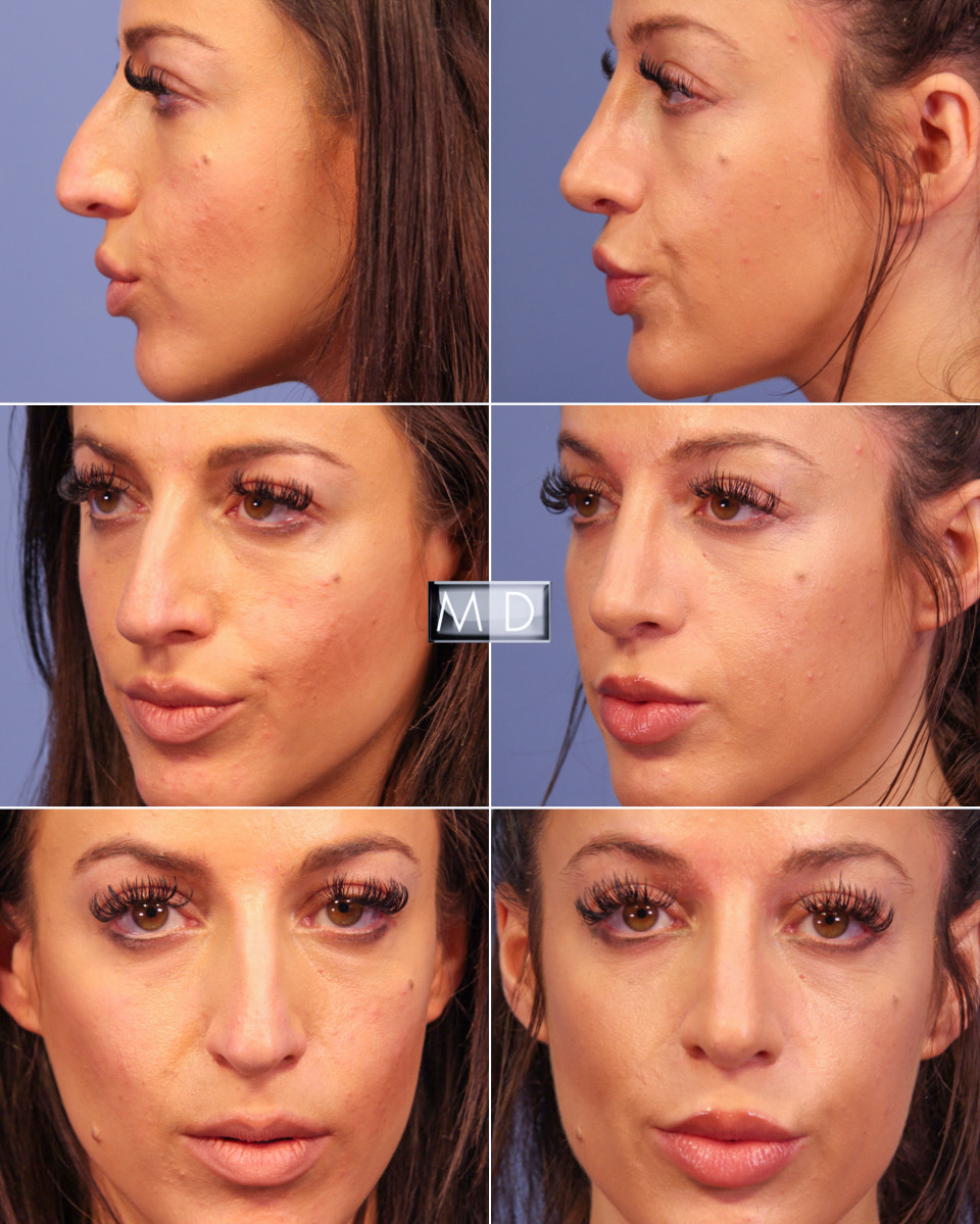 Dr Deuber - Rhinoplasty 4 - Lemmon Avenue Plastic Surgery & Laser ...