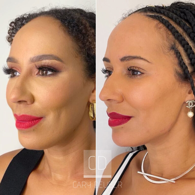 Cary - Facial Balancing 2 - Lemmon Avenue Plastic Surgery & Laser ...