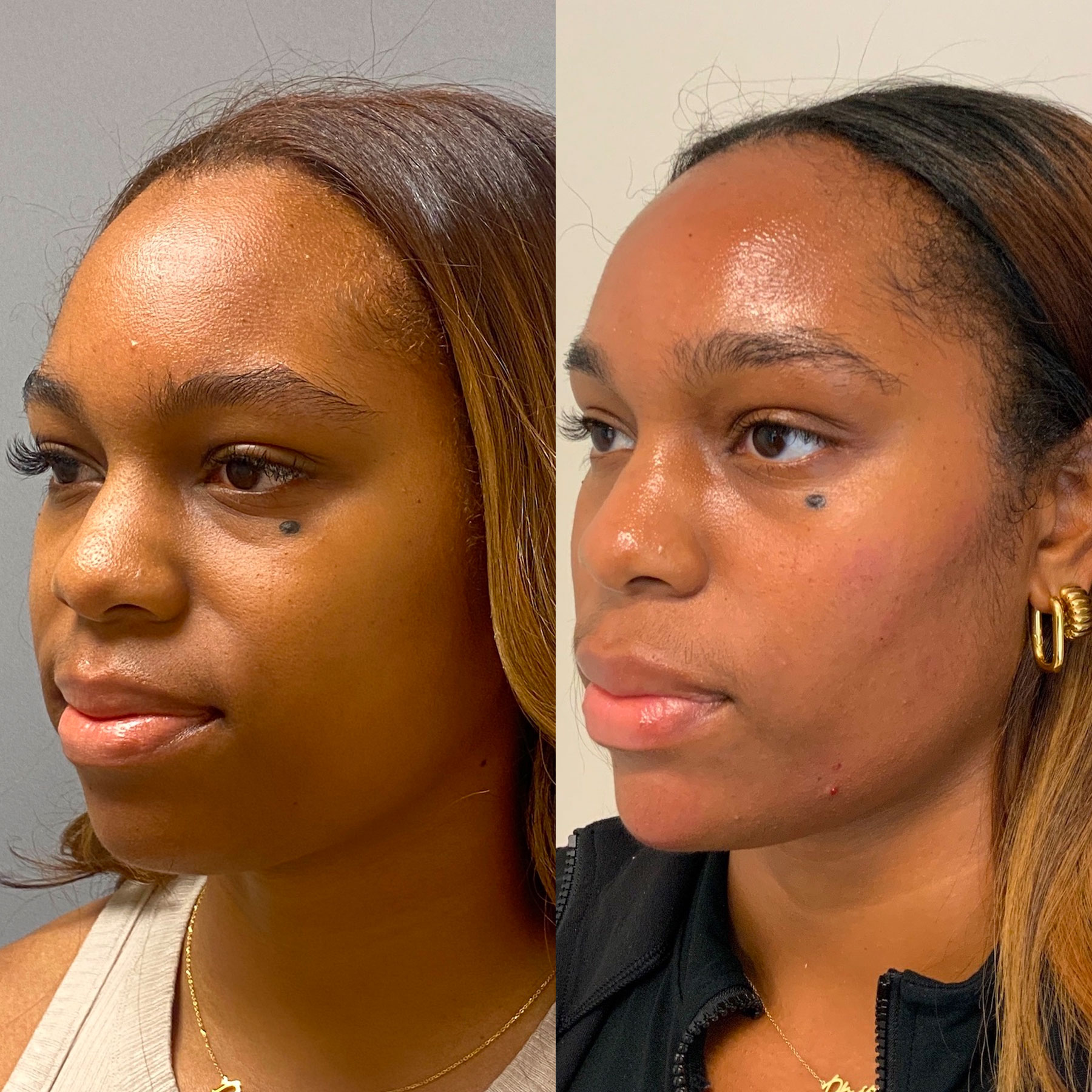 Facial Balancing Archives - Lemmon Avenue Plastic Surgery & Laser ...