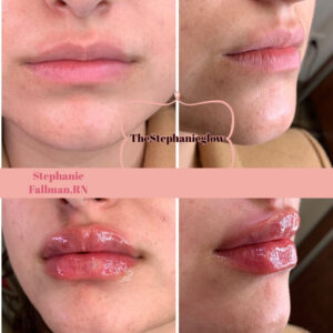 Lip Fillers in Dallas - Lemmon Avenue