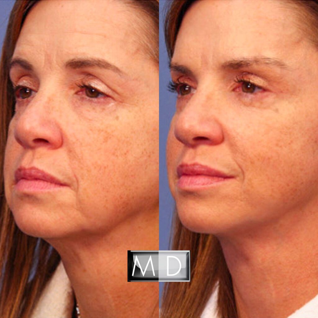 Before & After Archive - Lemmon Avenue Plastic Surgery & Laser Center ...