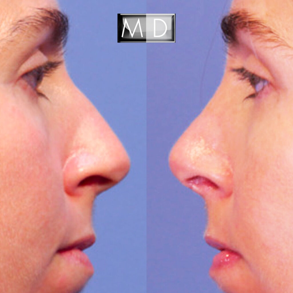 Before & After Archive - Lemmon Avenue Plastic Surgery & Laser Center ...