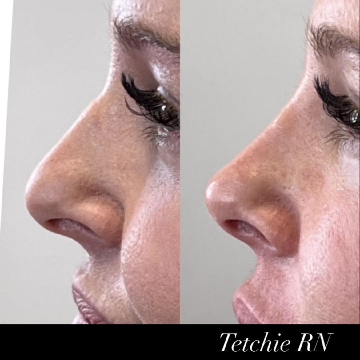 Tetchie - NSNJ nose 2 - Lemmon Avenue Plastic Surgery & Laser Center ...