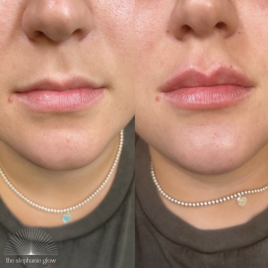 Lip Fillers in Dallas - Lemmon Avenue