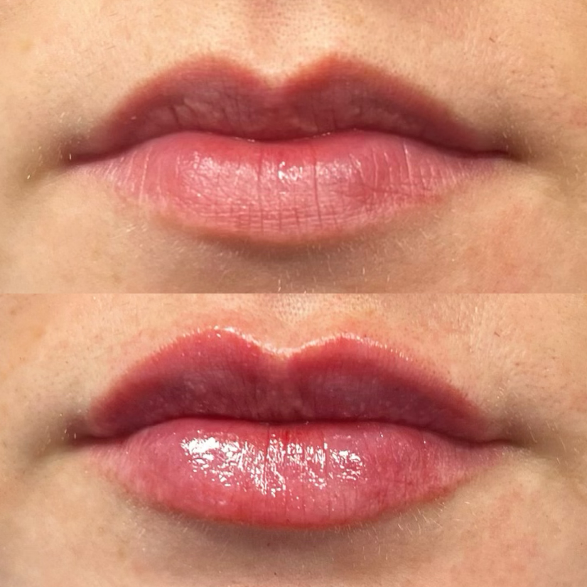 Paige - Lip Filler 6 - Lemmon Avenue Plastic Surgery & Laser Center ...