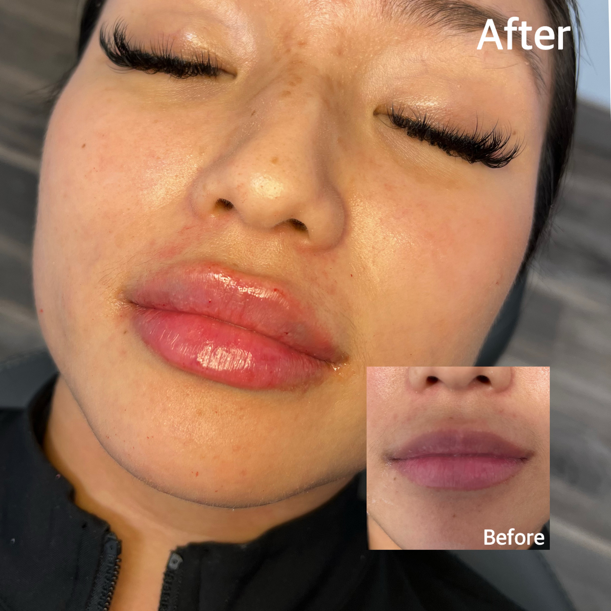 Paige - Lip Filler 1 - Lemmon Avenue Plastic Surgery & Laser Center ...