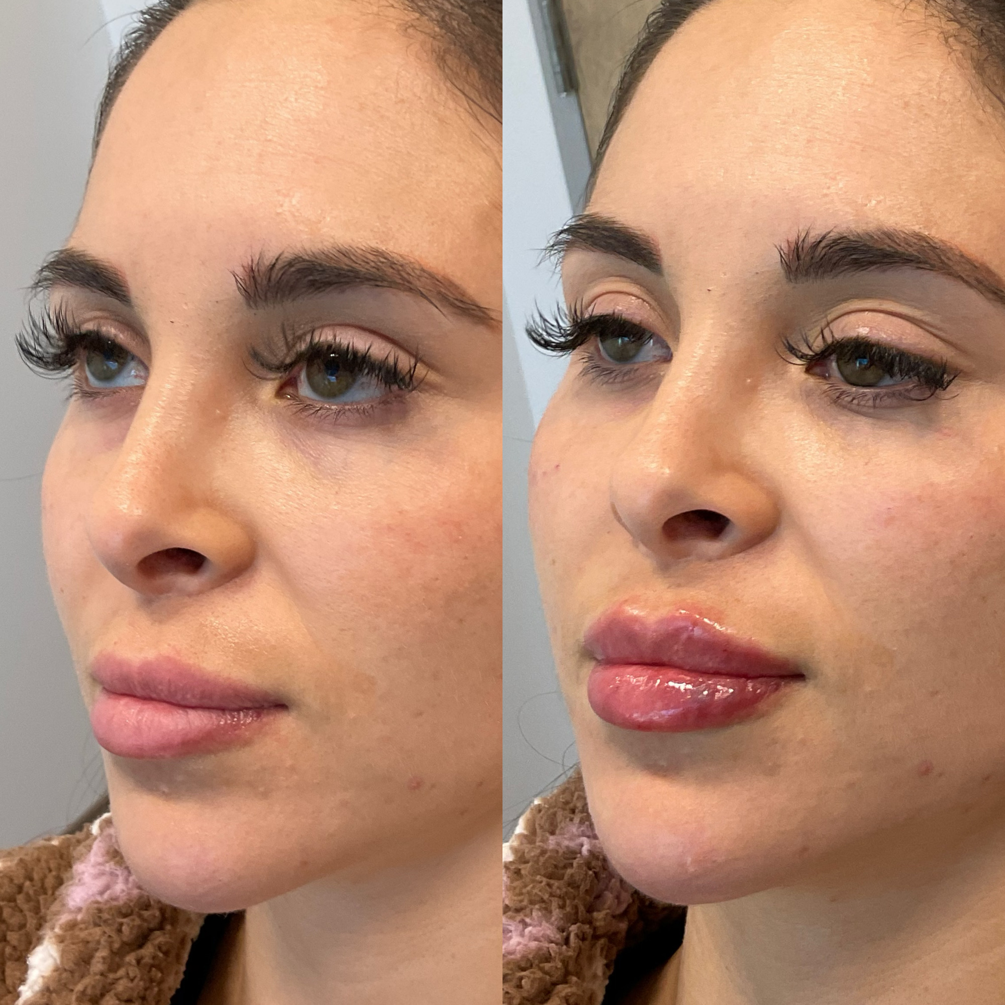 Paige - Lip Filler 7 - Lemmon Avenue Plastic Surgery & Laser Center ...