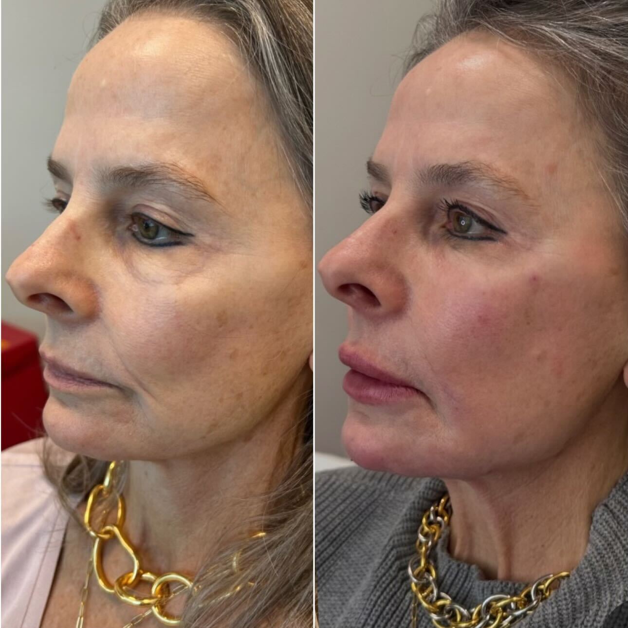 Payton - Full Face Filler - Lemmon Avenue Plastic Surgery & Laser ...